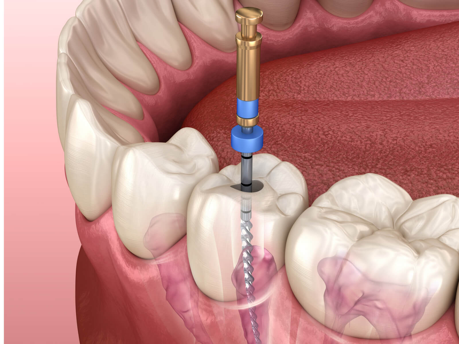 Root Canal Recovery Tips | Winnie Dentist TX